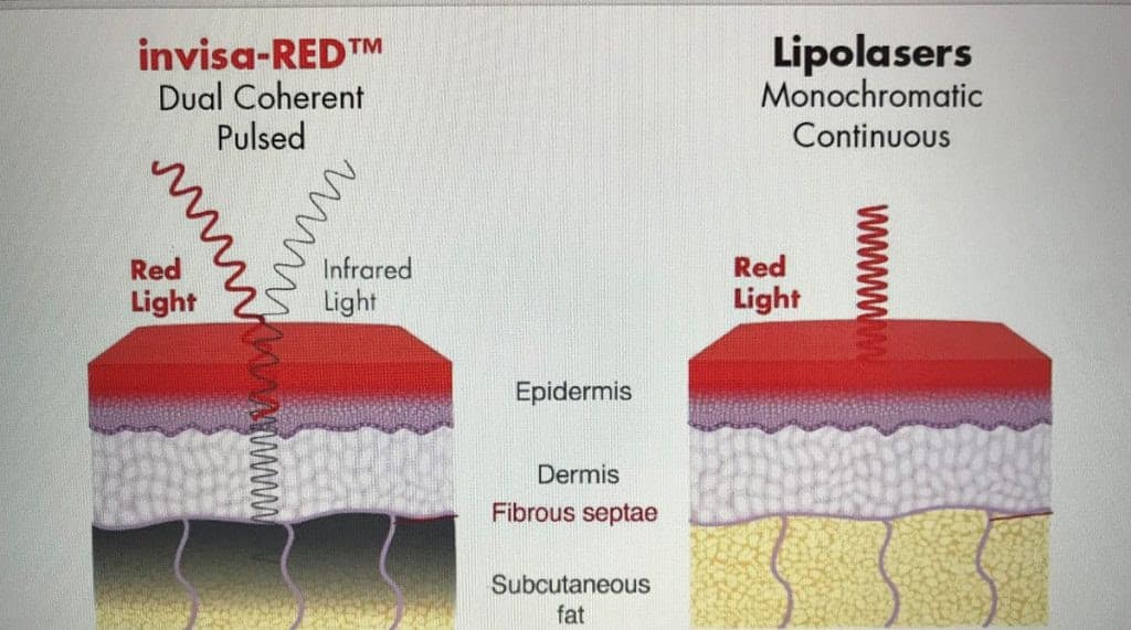 InvisaRed Treatment Suwanee GA - Laser light therapy Duluth